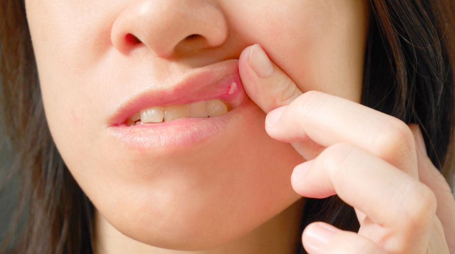 Mouth-related problems and their home remedies - The Statesman