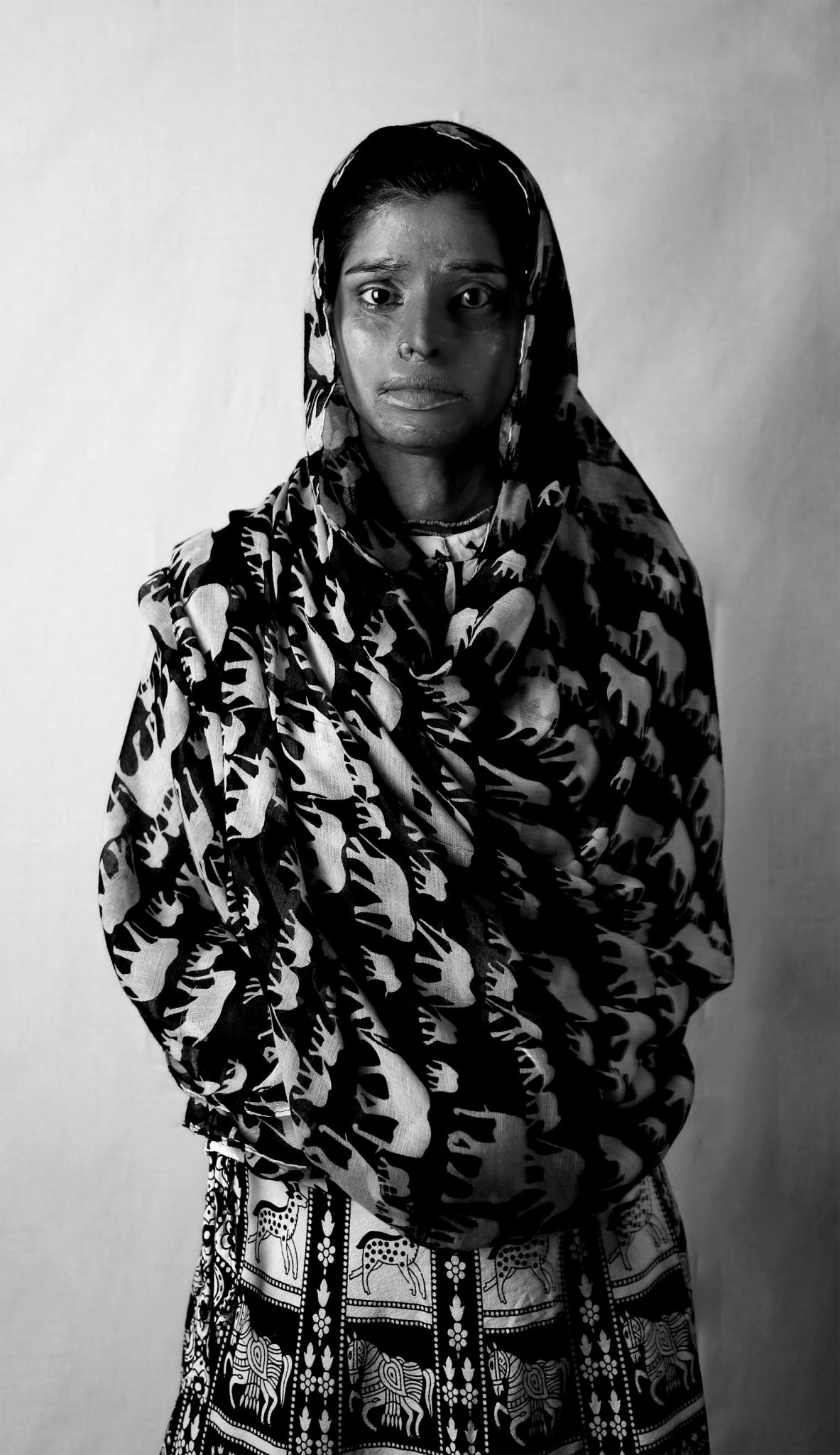 Photo exhibition on acid attack survivors holds mirror to the world ...